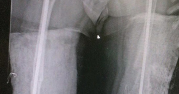 Telescopic Nail